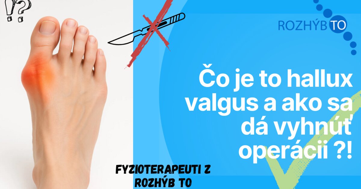 Čo je to hallux valgus a ako sa dá vyhnúť operácii